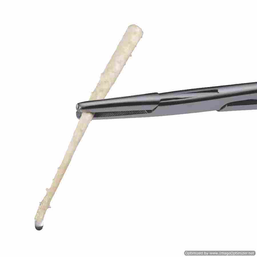 Clinical trial to test efficacy of fistula plug